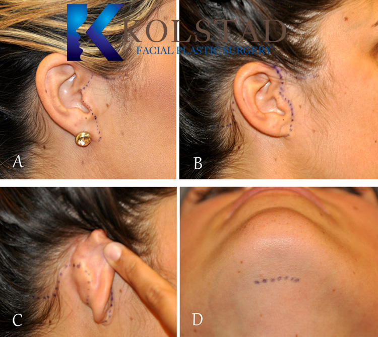 Facelift San Diego Dr Kolstad Facial Plastics Only