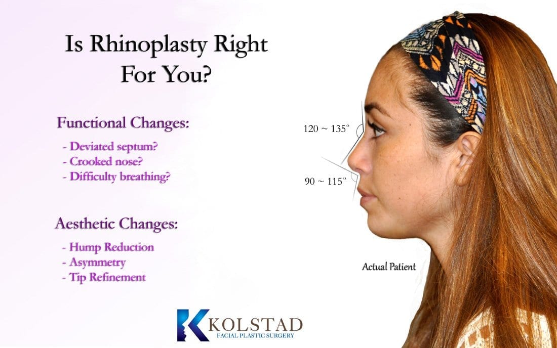 Rhinoplasty in San Diego CA | Dr. Kolstad - San Diego Facial Plastic ...
