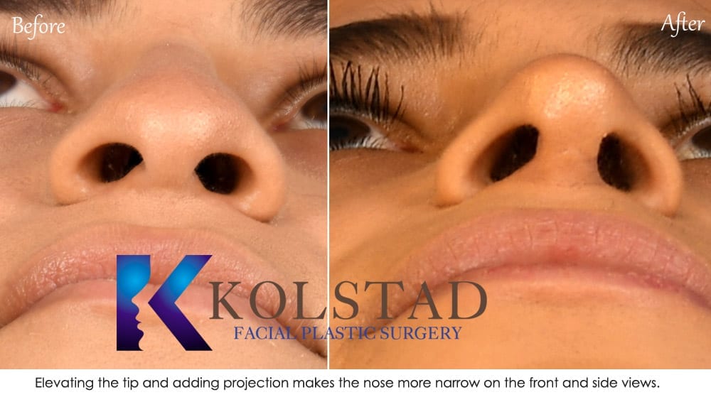 Rhinoplasty Results San Diego, Nose Job Pictures